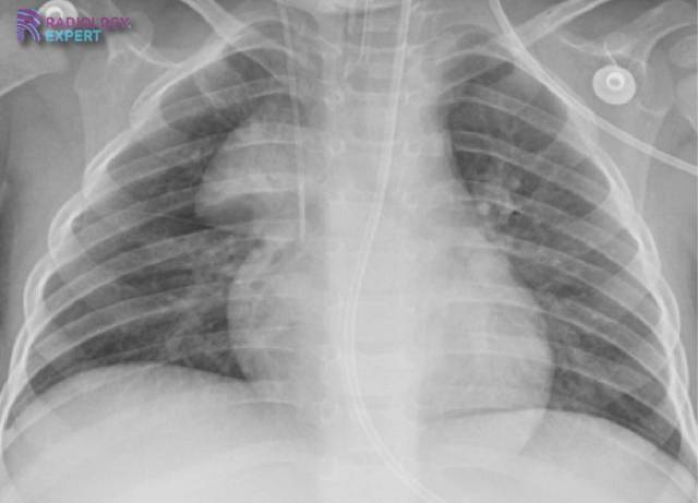 Normal Chest X Rays Pictures Chest X Ray Findings In 636 Ambulatory